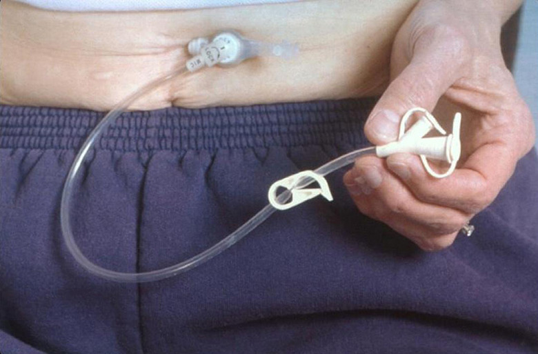 Percutaneous Endoscopic Gastrostomy Dr Harshad Joshi Percutaneous Endoscopic Gastrostomy Dr Harshad Joshi